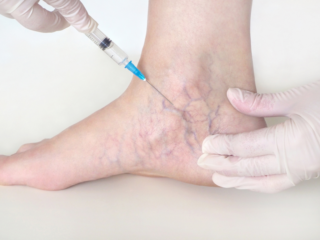 Tratamiento Varices – Clínica Centenario